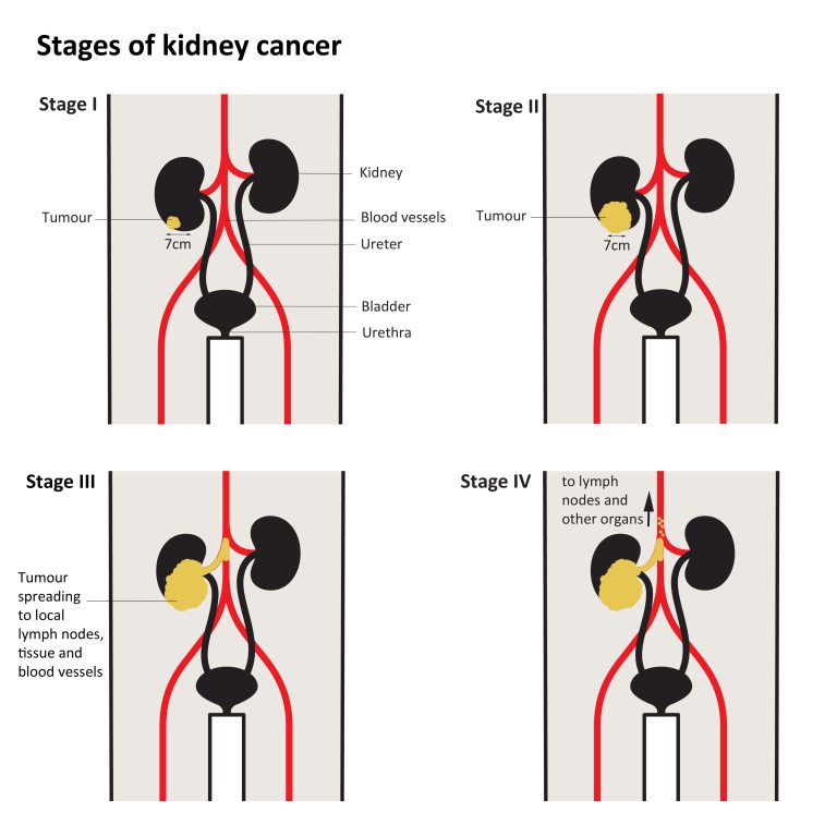 Kidney cancer - Kidney Health Australia